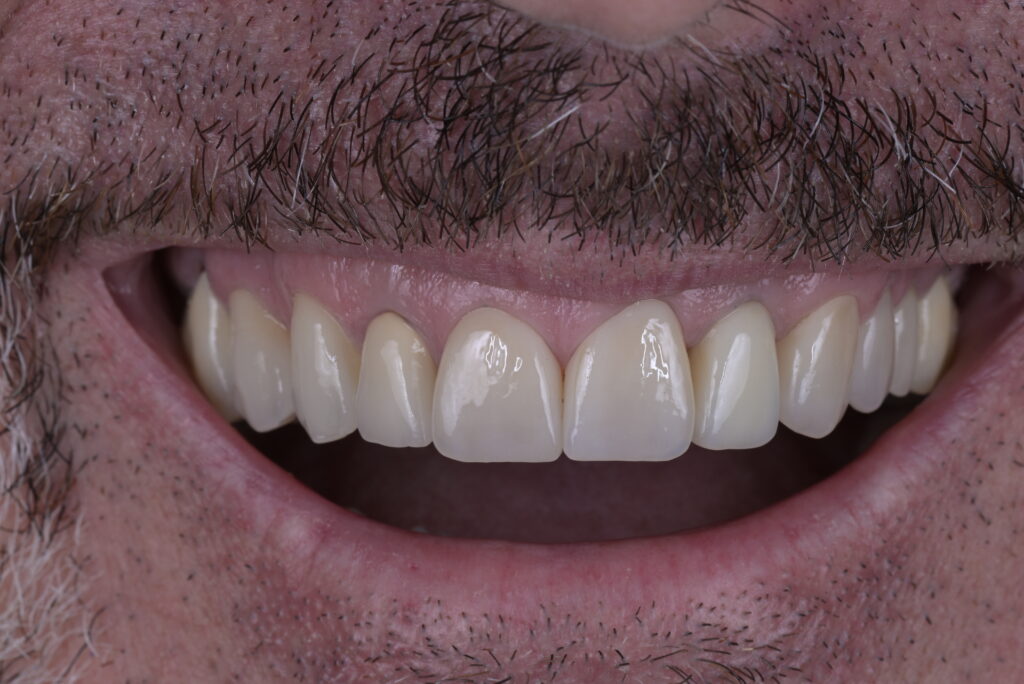 Case Study: 2D-to-3D Planning for zirconia-oxide veneers - Dr. Dario Novak